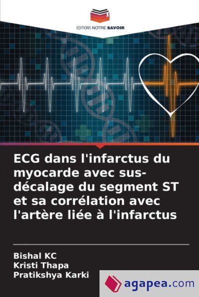 ECG DANS LA INFARCTUS DU MYOCARDE AVEC SUS-DA©CALAGE DU SEGMENT ST ET ...